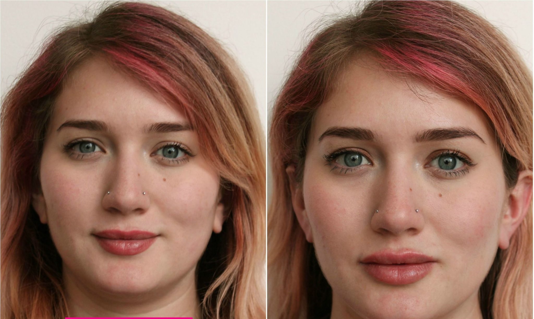 Lip Filler Side Effects and How to Manage Them