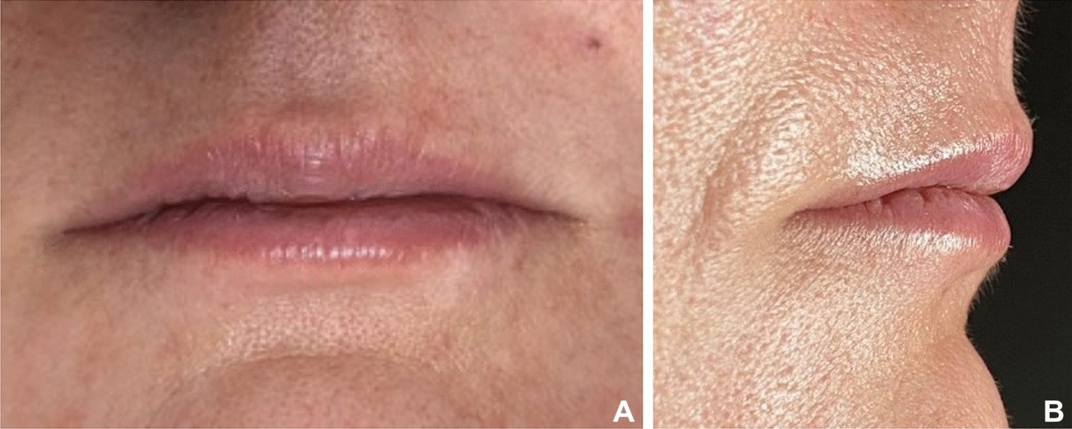 Lip Filler Results: Realistic Expectations vs. Reality